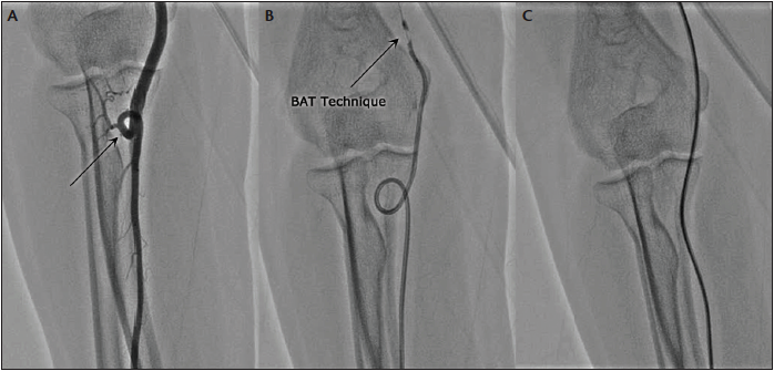 Radial PCI - Cardiac Interventions Today