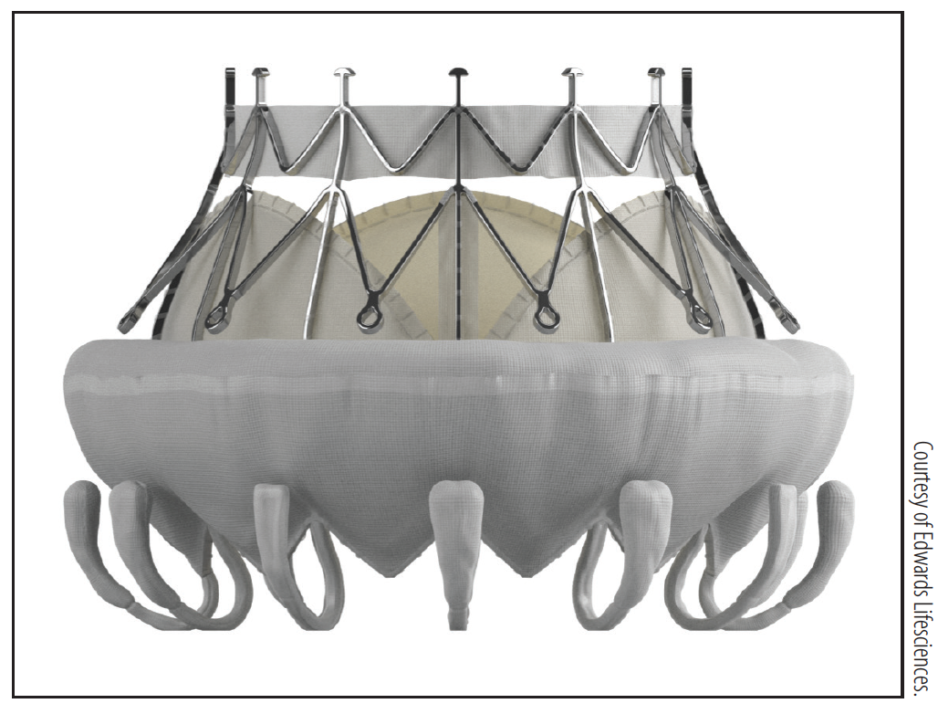 Percutaneous Mitral Valve Replacement - Cardiac Interventions Today
