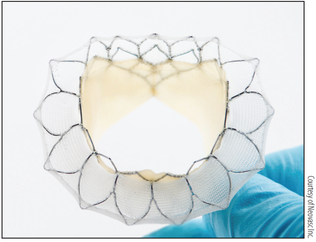 Percutaneous Mitral Valve Replacement - Cardiac Interventions Today