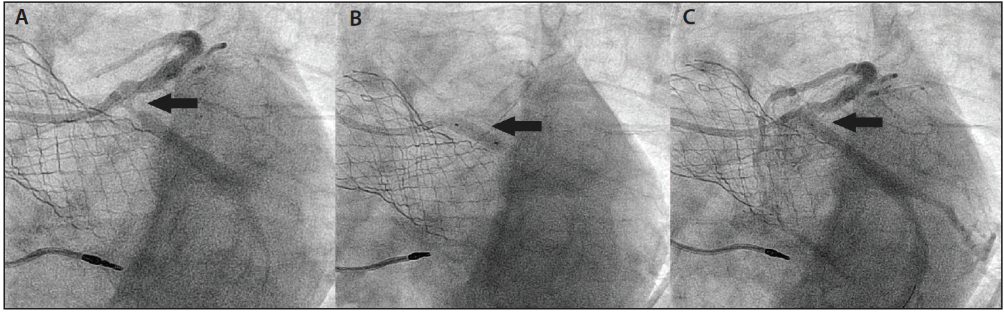 Ask the Experts: What Is Your Institution's Approach to CAD in TAVR ...