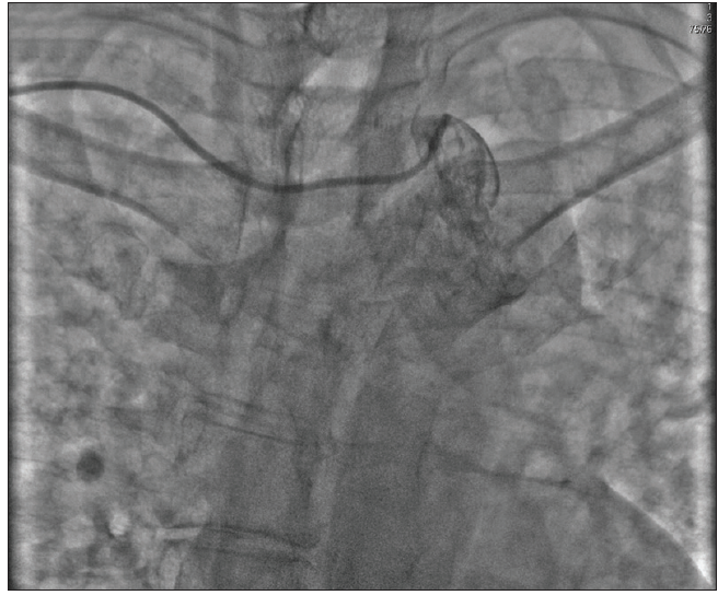 Essential Equipment for Radial Access Problem Solving - Cardiac ...