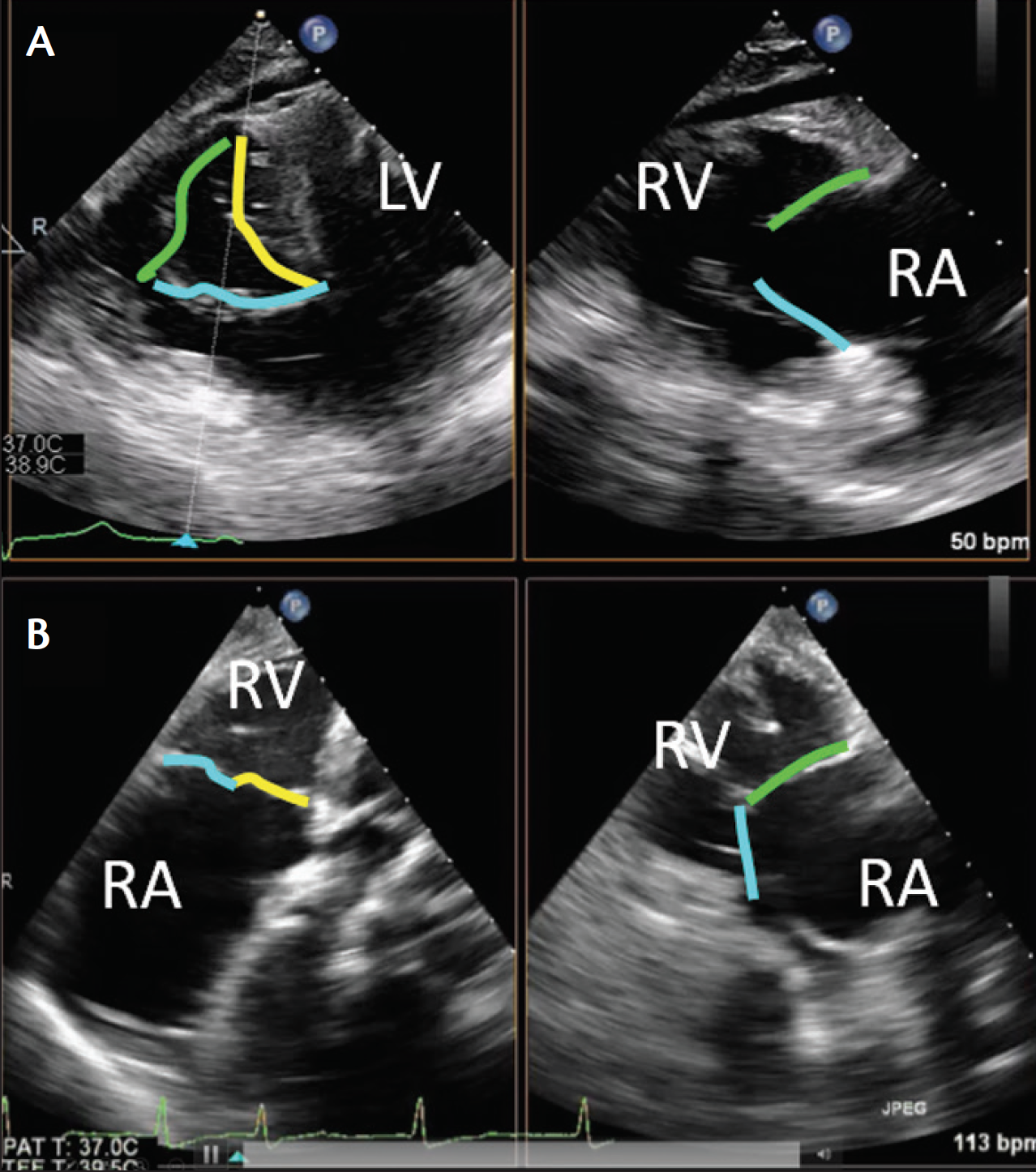 Imaging Considerations for Percutaneous Tricuspid Intervention ...