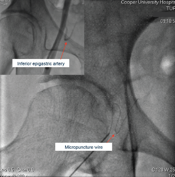 Femoral Versus Radial Access: Do Vascular Closure Devices Level the ...
