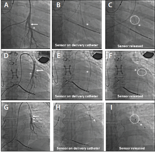 How to Implant the CardioMEMS Heart Failure Sensor - Cardiac ...