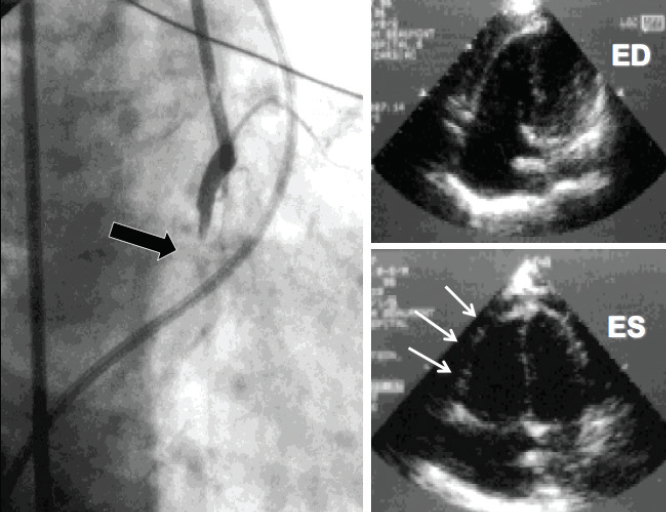 Acute Right Ventricular Failure - Cardiac Interventions Today