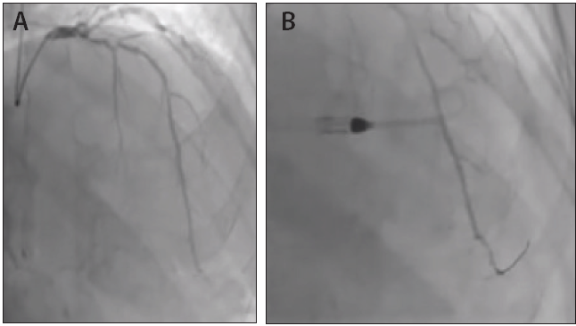 A Case of Complex, High-Risk, and Indicated PCI - Cardiac Interventions ...