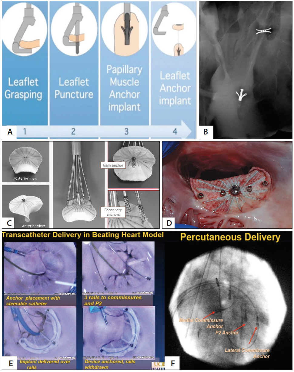 Transcatheter Chordal Repair for Degenerative Mitral Regurgitation ...