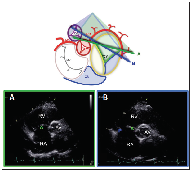Echocardiography for Tricuspid Valve Intervention - Cardiac ...