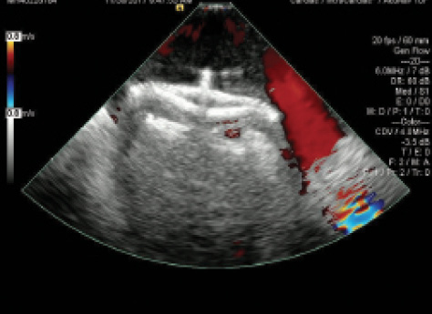 PFO Closure in Patients With Cryptogenic Stroke - Cardiac Interventions ...