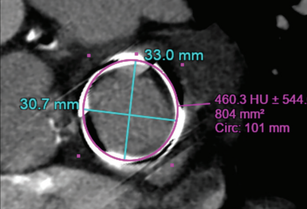 CT Assessment Before TMVR - Cardiac Interventions Today