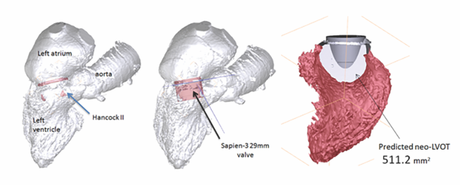 CT Assessment Before TMVR - Cardiac Interventions Today