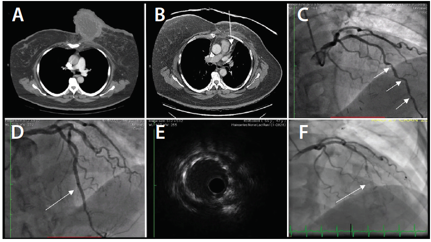 PCI in Patients With Cancer - Cardiac Interventions Today