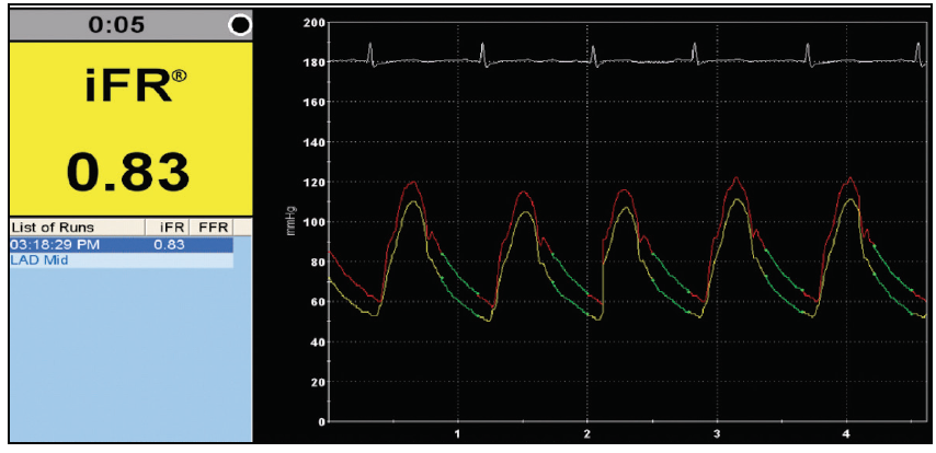 PCI in Patients With Cancer - Cardiac Interventions Today