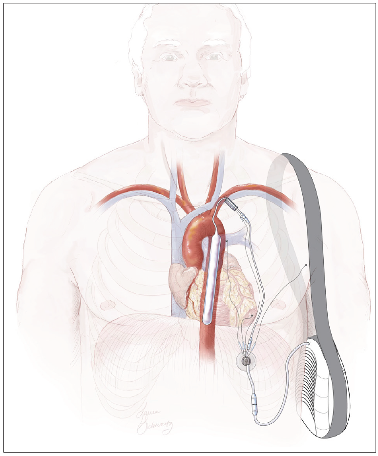 The Next Wave of Mechanical Circulatory Support Devices - Cardiac ...