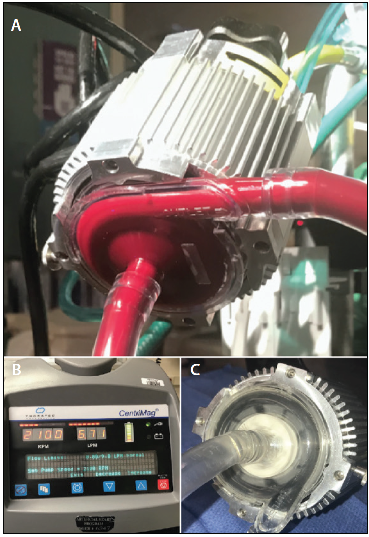 Right Ventricular Support Options - Cardiac Interventions Today