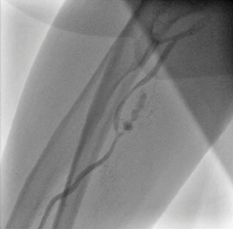 Navigating Complex Radial Loops - Cardiac Interventions Today