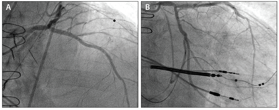 Case Report: Antiplatelet Therapy After Complex PCI in the ...
