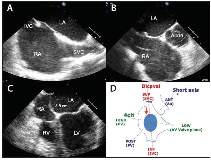 Transseptal Puncture: A Step-by-Step Procedural Guide - Cardiac ...