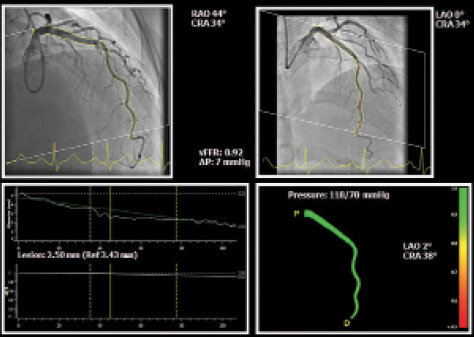 Angiography-Based FFR: Reevaluating the Role of the Pressure Wire ...