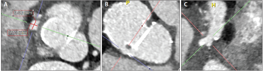 Transcatheter Paravalvular Leak Closure: Diagnosis, Devices, Techniques ...