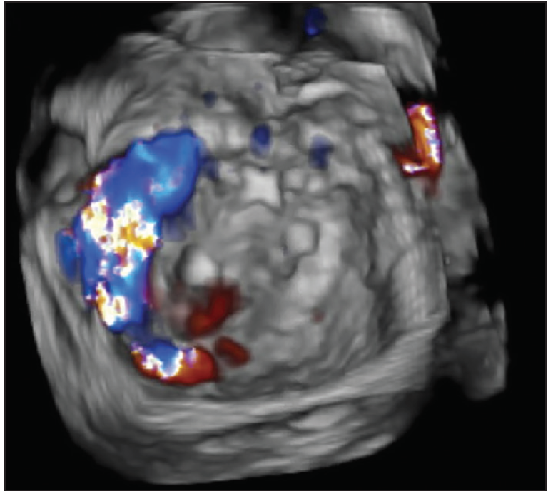 Transcatheter Paravalvular Leak Closure: Diagnosis, Devices, Techniques ...