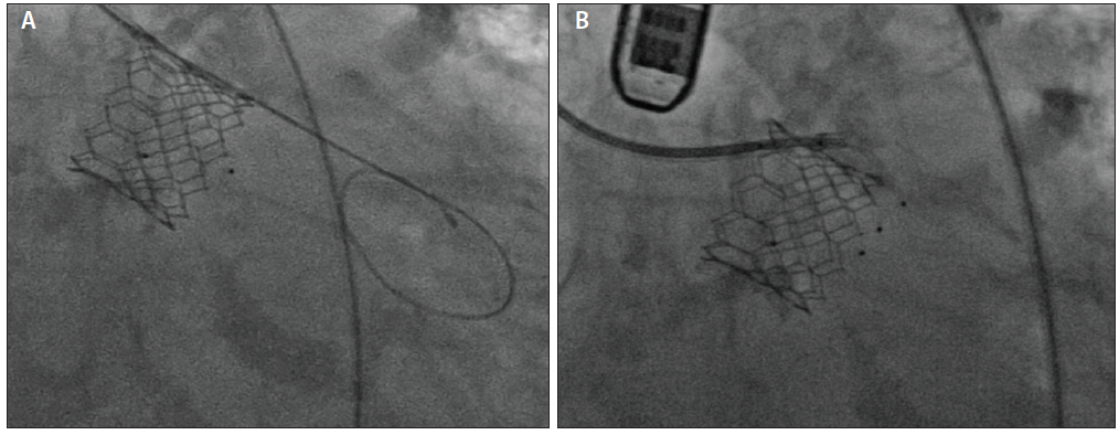 Transcatheter Paravalvular Leak Closure: Diagnosis, Devices, Techniques ...
