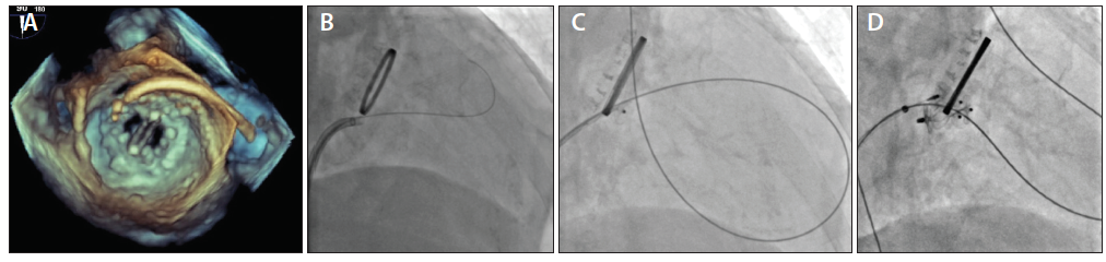 Transcatheter Paravalvular Leak Closure: Diagnosis, Devices, Techniques ...