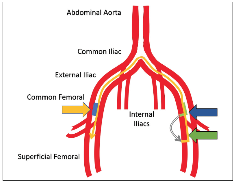 Large-Bore Access Site Management - Cardiac Interventions Today