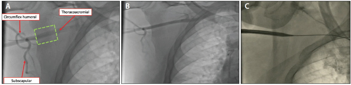 Large-Bore Access Site Management - Cardiac Interventions Today