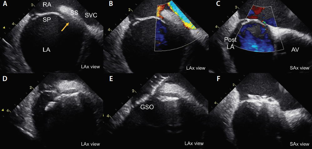 How to Close a PFO With ICE Guidance - Cardiac Interventions Today