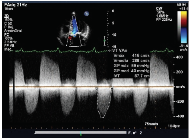 TAVR in Small Anatomy - Cardiac Interventions Today