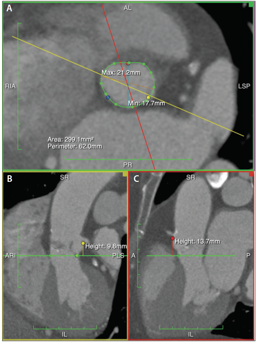 TAVR in Small Anatomy - Cardiac Interventions Today