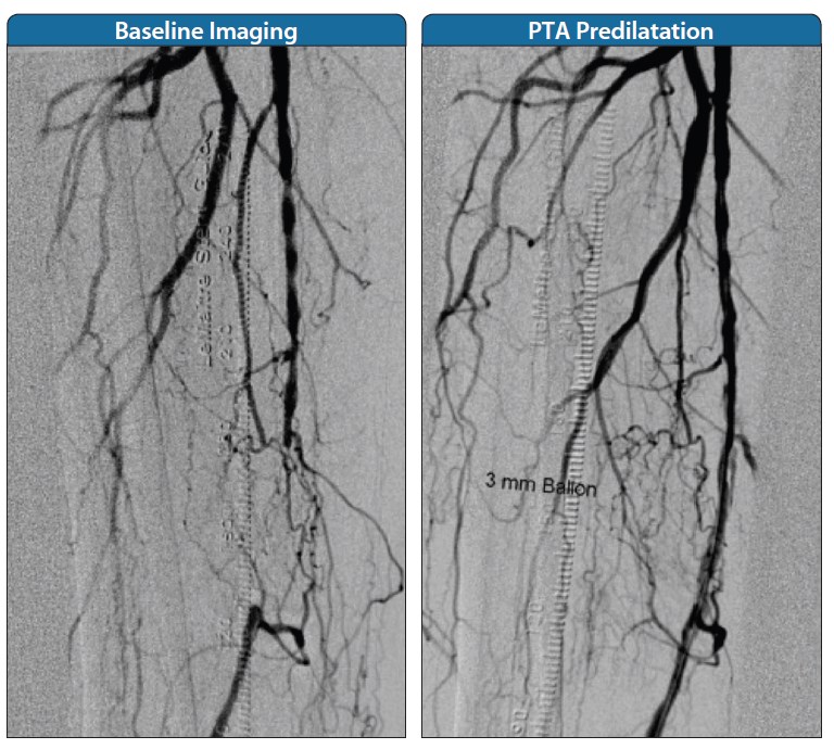 IN.PACT™ Admiral™ DCB Case Study - Endovascular Today