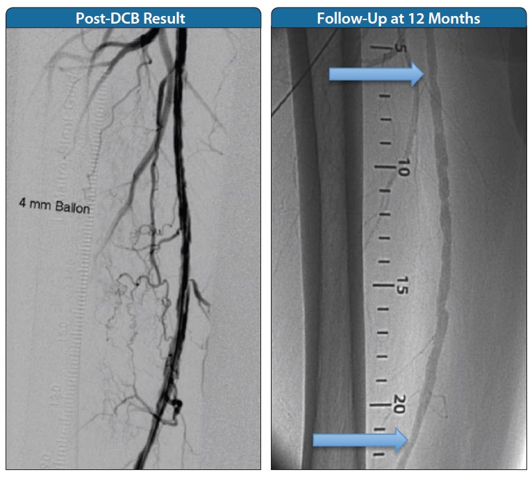 IN.PACT™ Admiral™ DCB Case Study - Endovascular Today