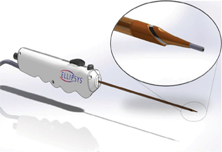 Update on Percutaneous AV Fistula Creation - Endovascular Today