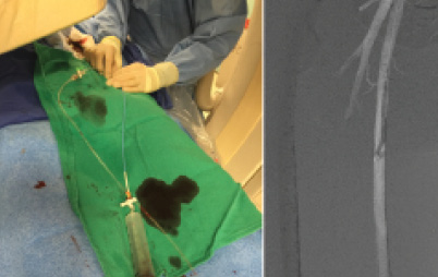 Treating Venous Thromboembolism Without Lytic Medications ...