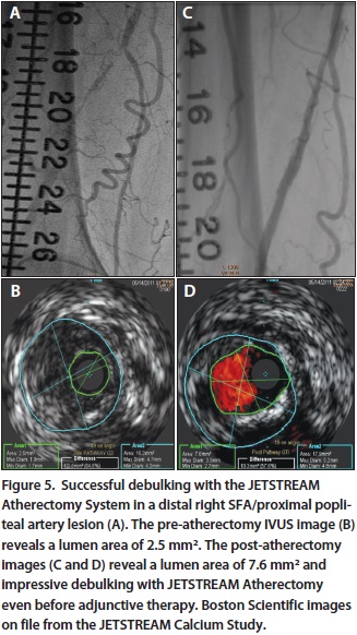 Key Learnings From the JETSTREAM Atherectomy Calcium Study ...