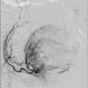 Total Fibroid Devascularization With Embozene™ Microspheres ...