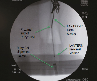 Evolution of Embolization - Endovascular Today