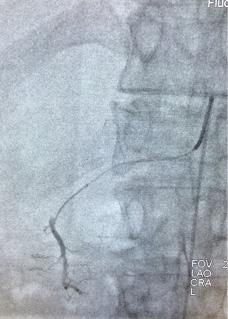 Evolution of Embolization - Endovascular Today