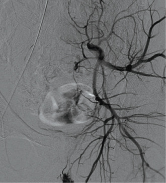 Embolization for High-Flow Priapism - Endovascular Today