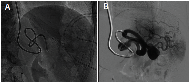 Expand Your Confidence in Embolisation Treatment: Ruby Coil and POD ...