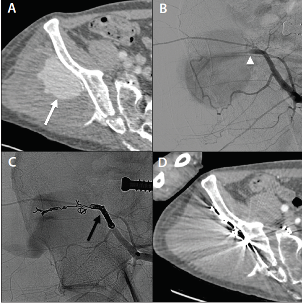 Evolution of Embolization - Endovascular Today