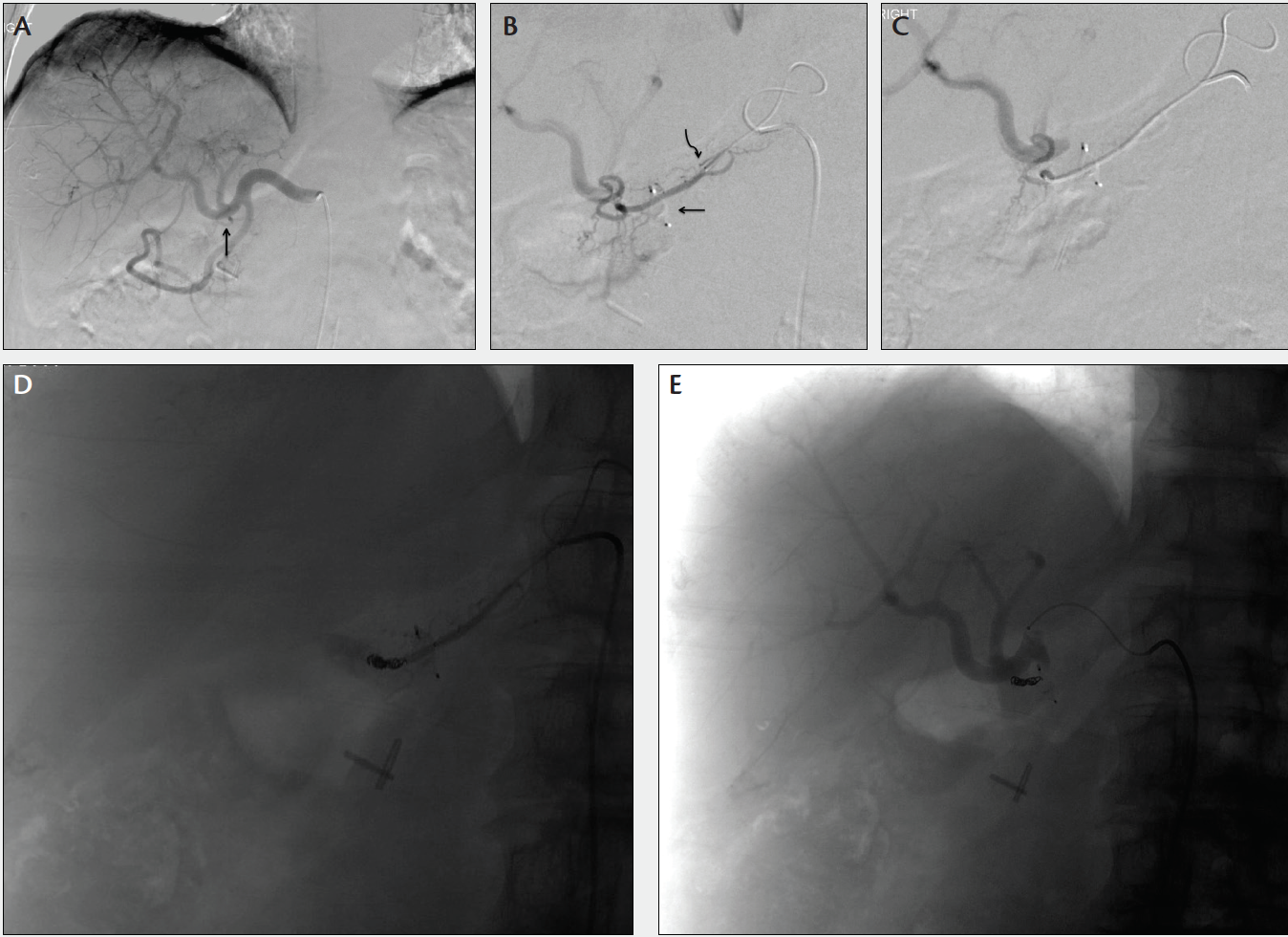 Yttrium-90 Radioembolization Mapping and Therapy - Endovascular Today