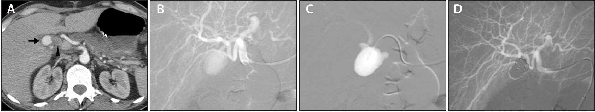 Embolization for Upper GI Bleeding - Endovascular Today