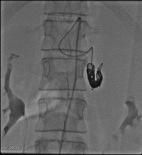 Expand Your Confidence in Embolisation Treatment: Ruby Coil and POD ...