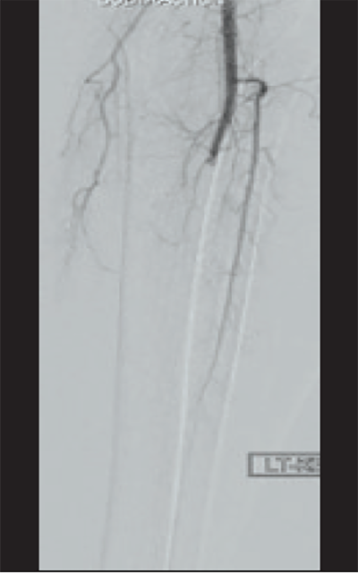 Indigo® System for Thromboembolic Disease - Endovascular Today