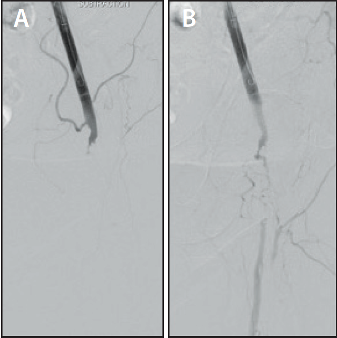 Indigo® System for Thromboembolic Disease - Endovascular Today
