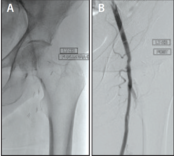 Indigo® System for Thromboembolic Disease - Endovascular Today