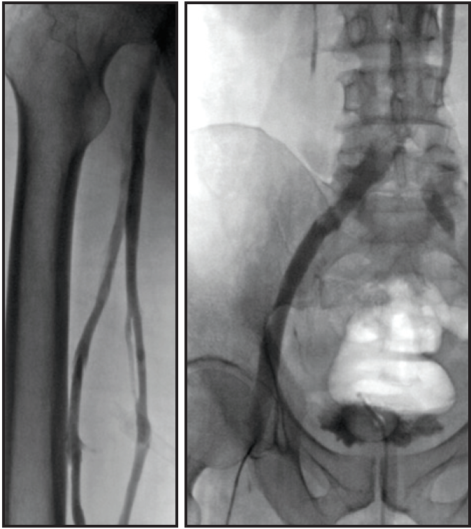 Indigo® System for Thromboembolic Disease - Endovascular Today